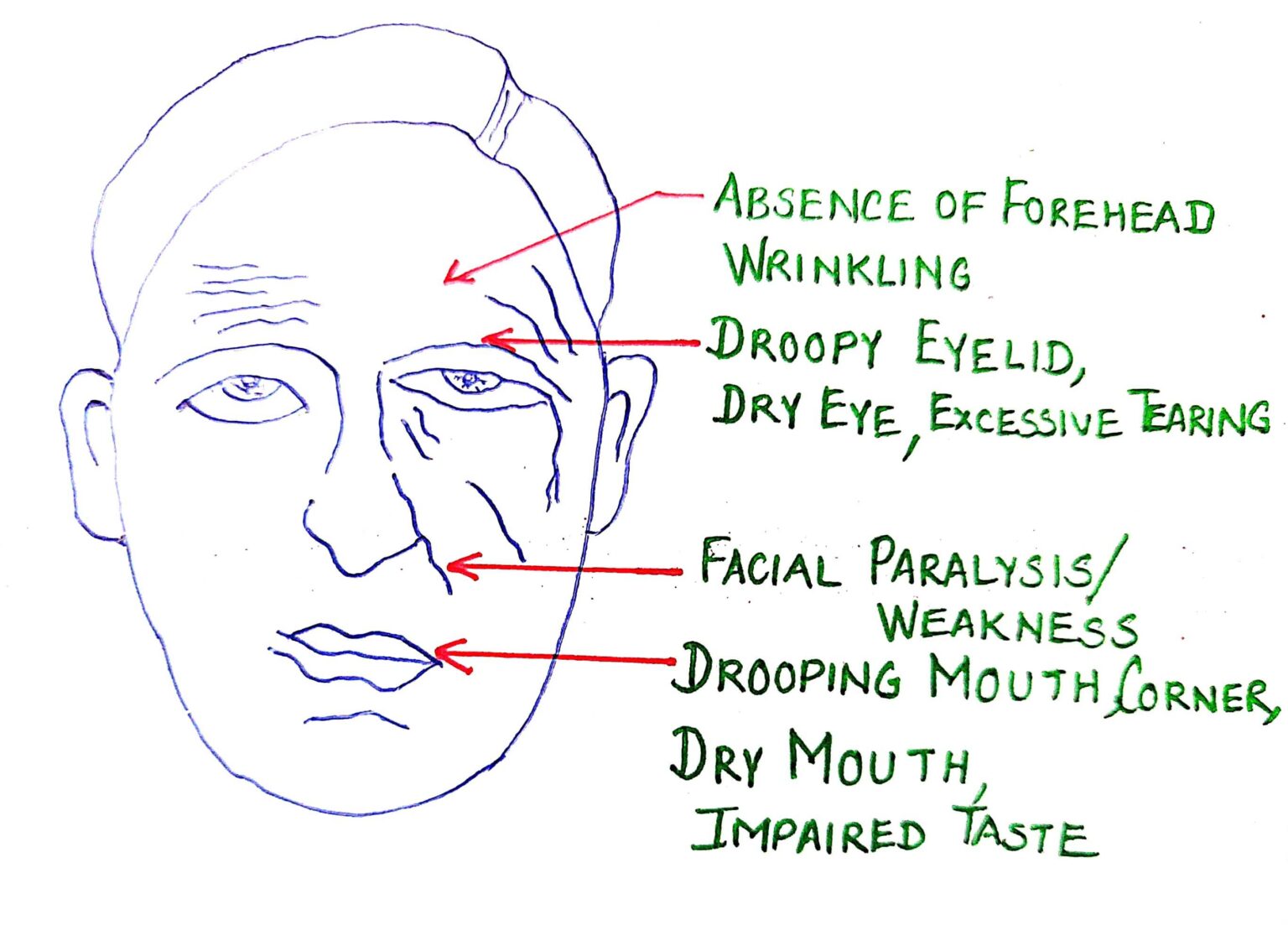 What are causes of Bell's Palsy